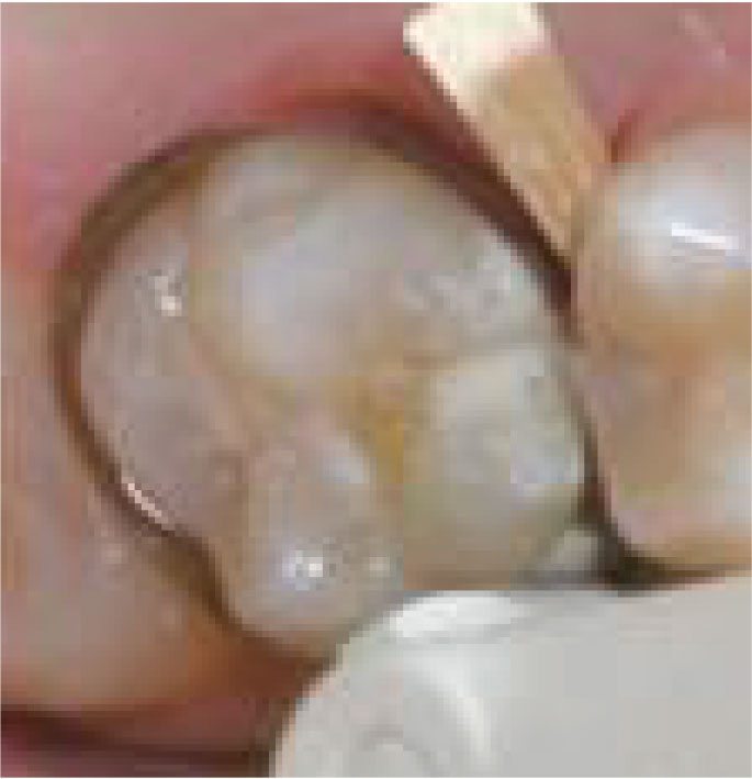 Mua Đai Trám Cỡ Mỏng Omni Matrix ️ VAT đầy đủ