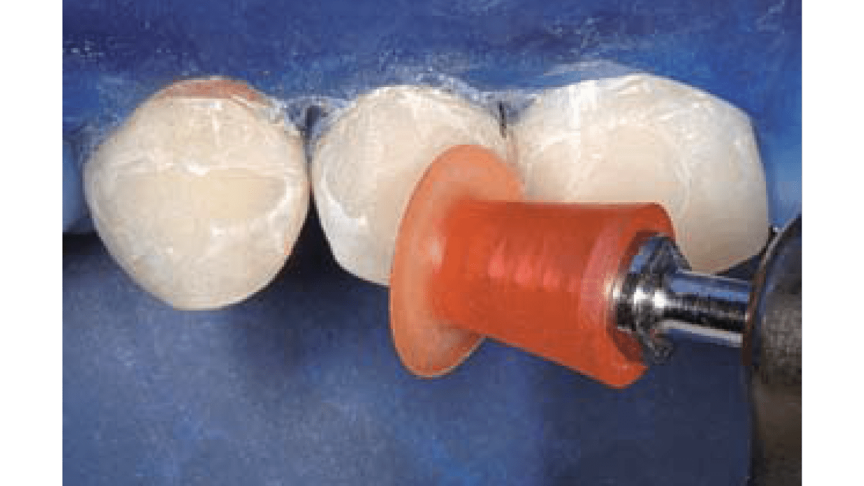 Mua Bộ Đĩa Đánh Bóng Composite - Flexipol ️ VAT đầy đủ