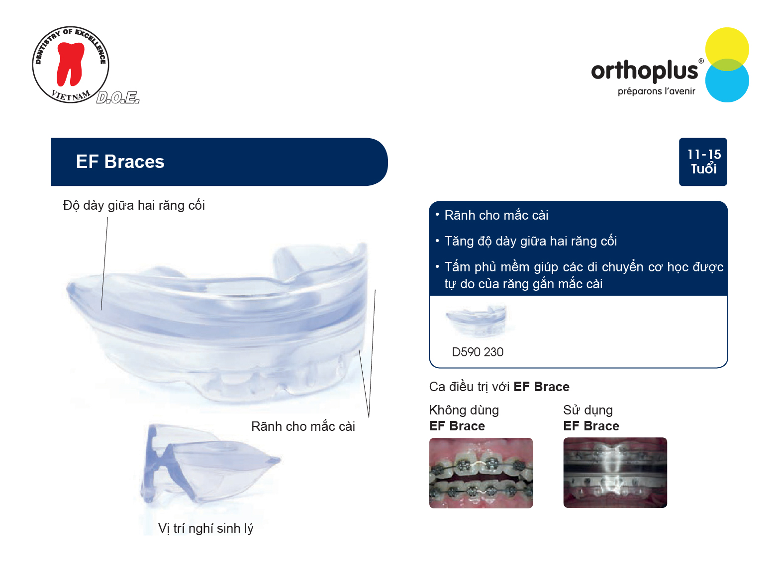 Khí cụ chức năng dành cho trẻ em và phương pháp điều trị hiệu quả - DOE Vietnam - Chuyên cung ...