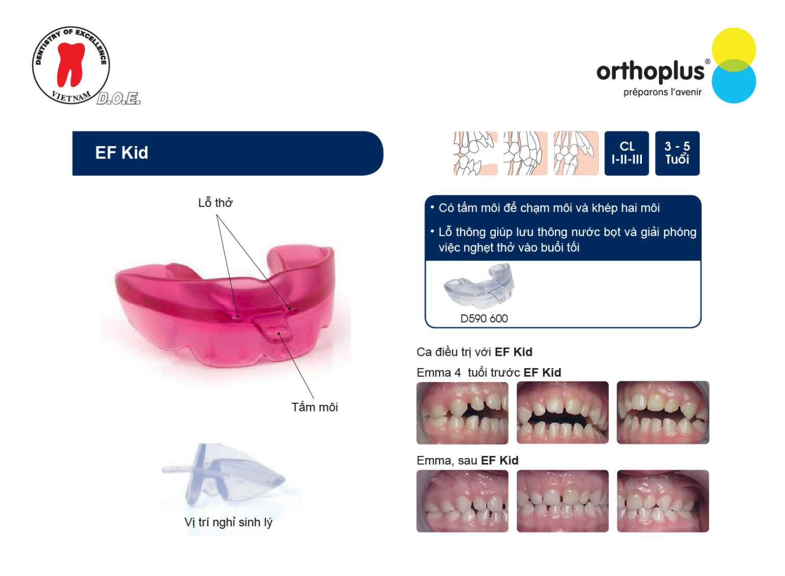 Khí cụ chức năng dành cho trẻ em và phương pháp điều trị hiệu quả - DOE Vietnam - Chuyên cung ...